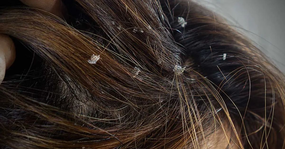 How to Choose the Best Dandruff Shampoo for Your Scalp
