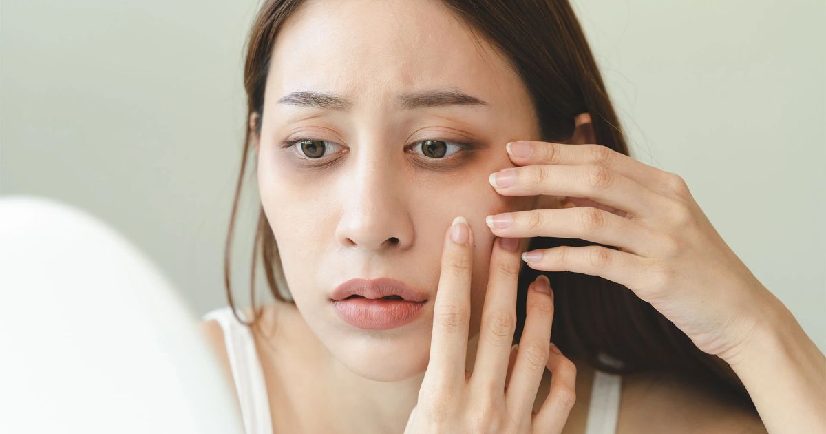 12 Proven Home Remedies for Dark Circles & Under Eye Bags