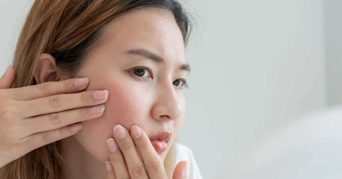 Your Essential Checklist for Seborrheic Dermatitis Care